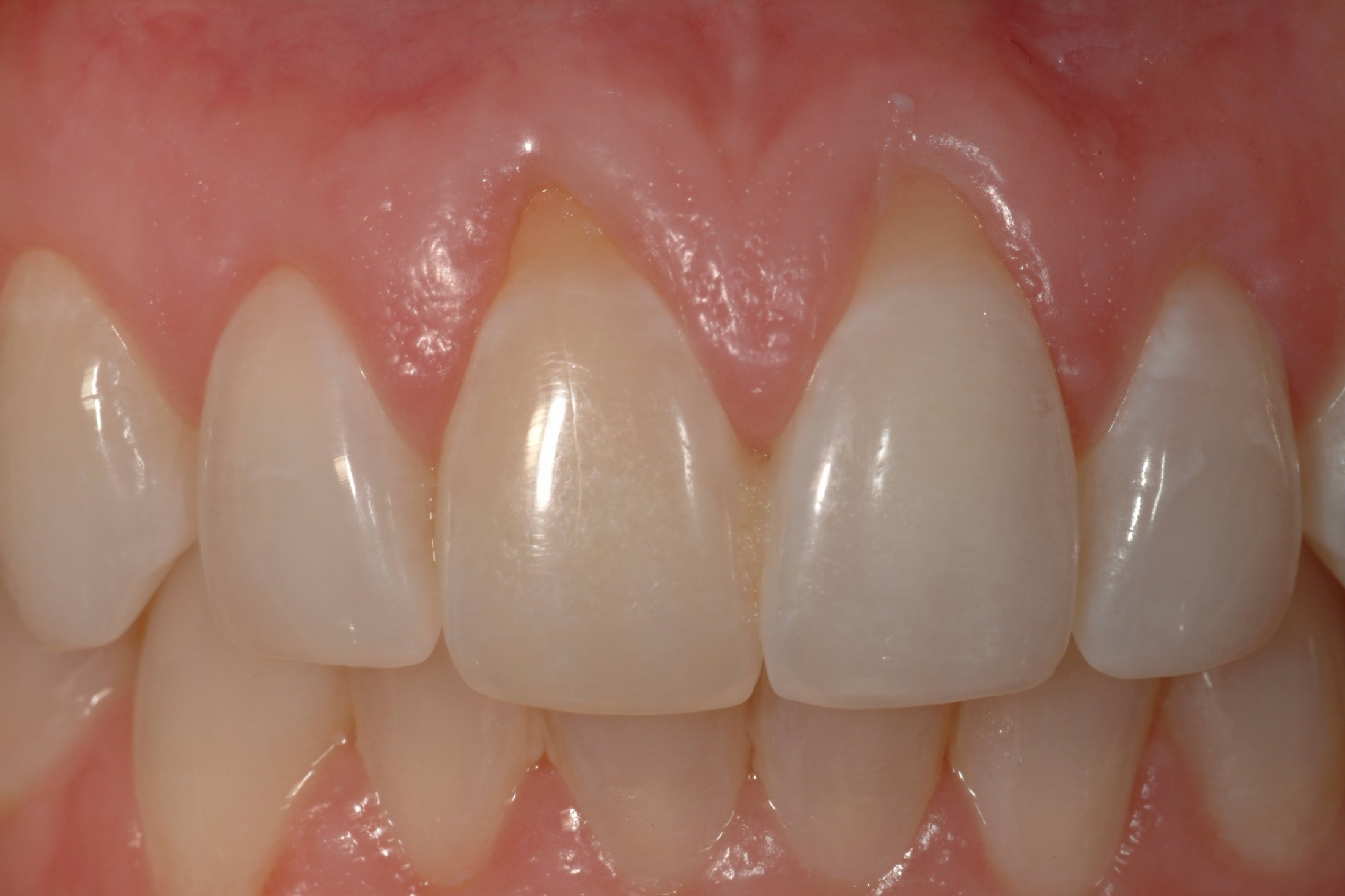 Periodontics Before & After Pictures Bellmore NY | Smile Gallery